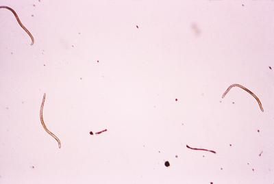 Oncocercosi: definizione e significato medico | Corriere Salute