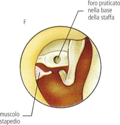 Stapedectomia: definizione e significato medico | Corriere Salute