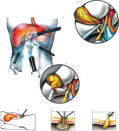 Colecistectomia: definizione e significato medico | Corriere Salute