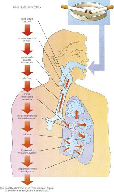 Bronchite: definizione e significato medico | Corriere Salute