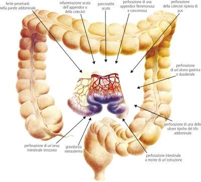 Peritonite: definizione e significato medico | Corriere Salute