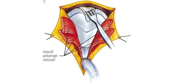 Laringectomia: definizione e significato medico | Corriere Salute