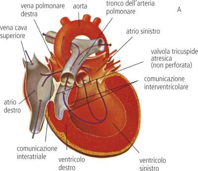 Atresia: definizione e significato medico | Corriere Salute
