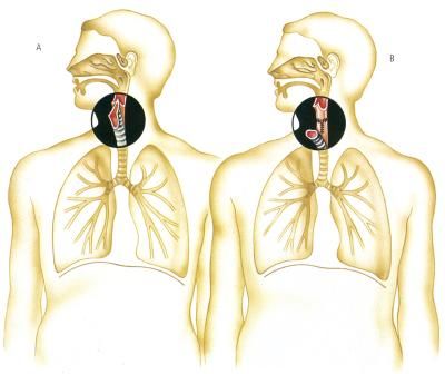 Laringectomia: definizione e significato medico | Corriere Salute