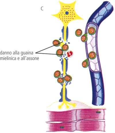 Sindrome di guillainbarre: definizione e significato medico | Corriere ...