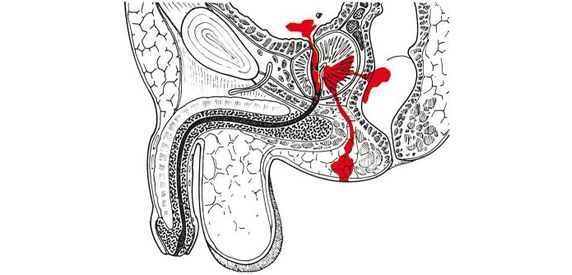 Prostatite: definizione e significato medico | Corriere Salute