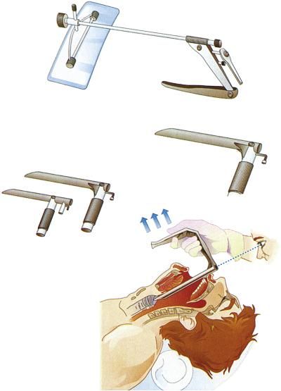 Laringoscopia: definizione e significato medico | Corriere Salute