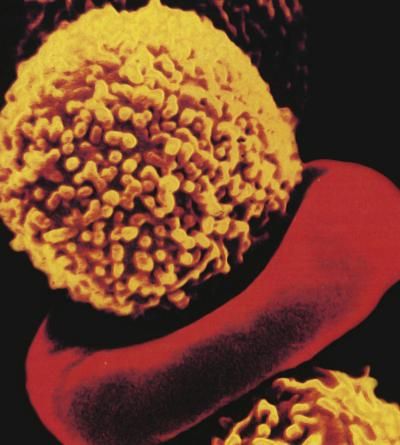 Leucemia: definizione e significato medico | Corriere Salute