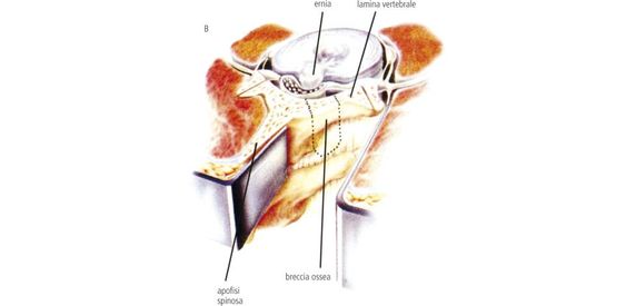 Discectomia: definizione e significato medico | Corriere Salute