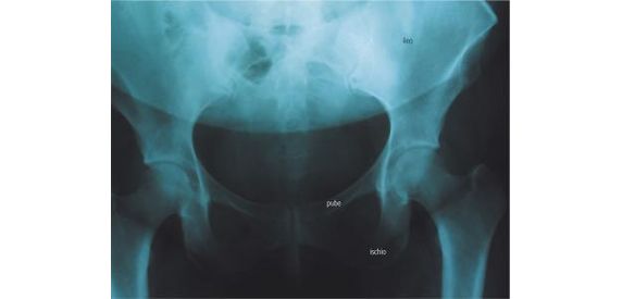 Osso iliaco: definizione e significato medico | Corriere Salute