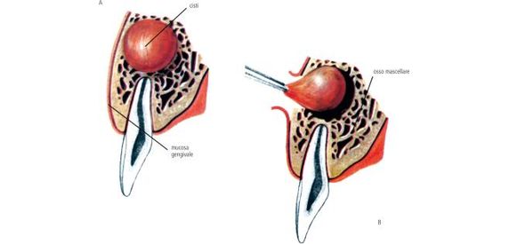 Cistectomia: definizione e ultime news | Corriere Salute