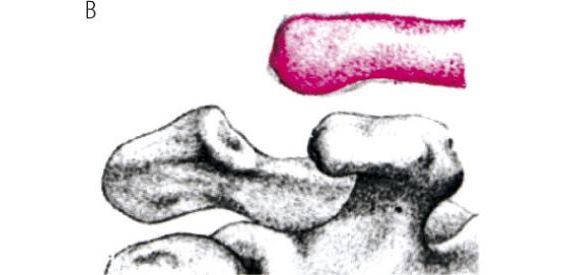 Frattura della clavicola: definizione e significato medico | Corriere ...