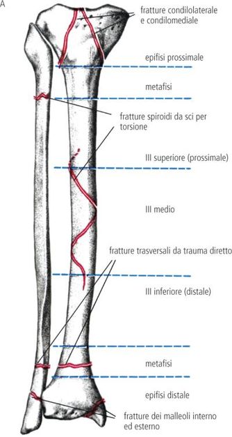 Frattura della gamba: definizione e significato medico | Corriere Salute