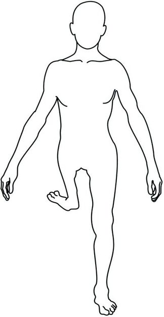 Focomelia: definizione e significato medico | Corriere Salute