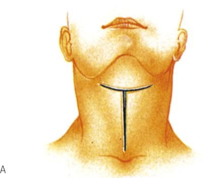 Laringectomia: definizione e significato medico | Corriere Salute