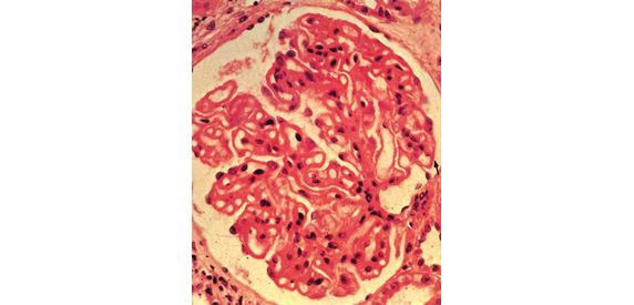 Sindrome nefrosica: definizione e ultime news | Corriere Salute