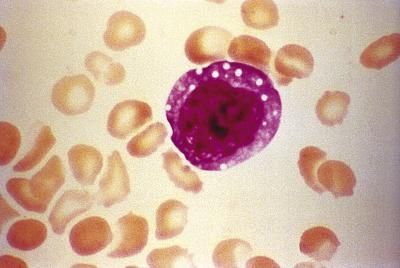 Linfocito: definizione e significato medico | Corriere Salute