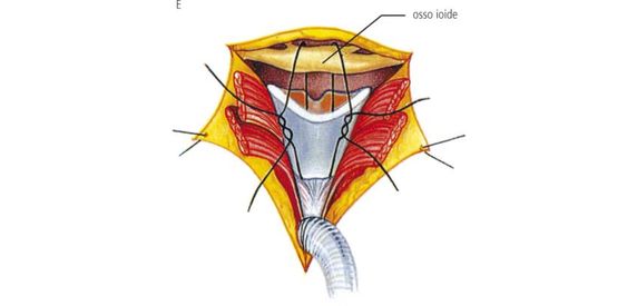 Laringectomia: definizione e significato medico | Corriere Salute