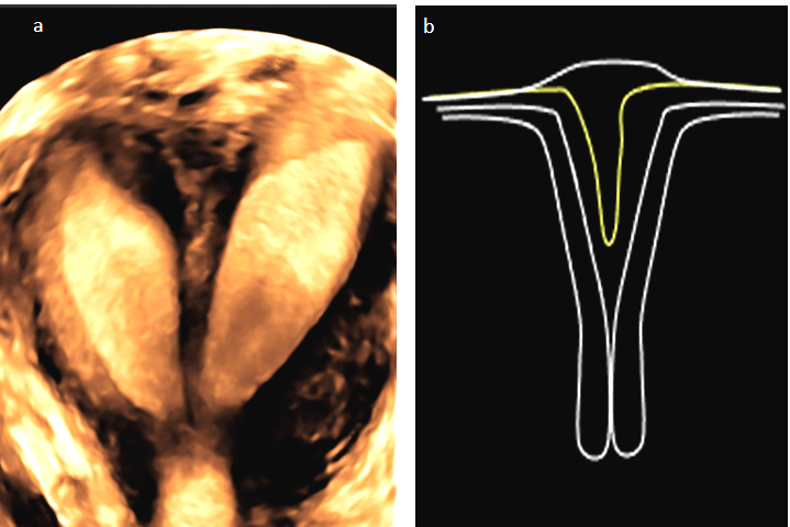 Utero setto: definizione e significato medico | Corriere Salute