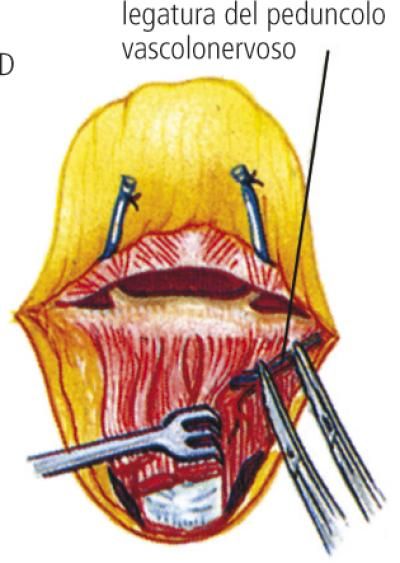 Laringectomia: definizione e significato medico | Corriere Salute