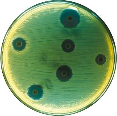 Setticopioemia: definizione e significato medico | Corriere Salute