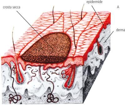 Crosta: definizione e significato medico | Corriere Salute