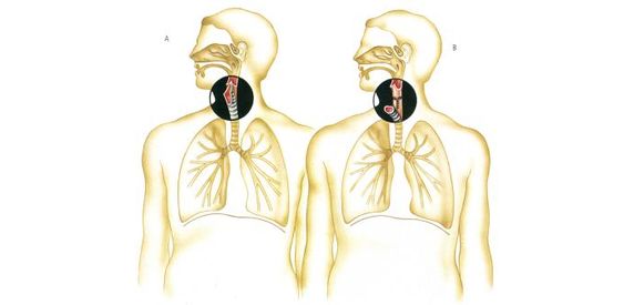 Laringectomia: definizione e significato medico | Corriere Salute