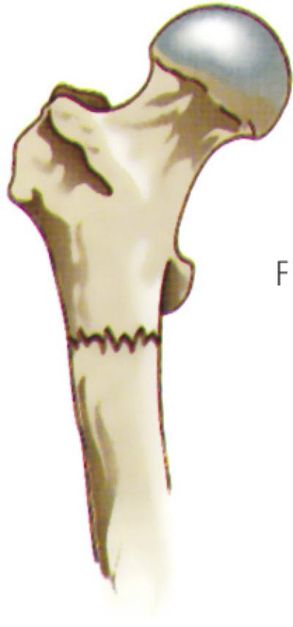 Frattura del collo del femore: definizione e significato medico ...
