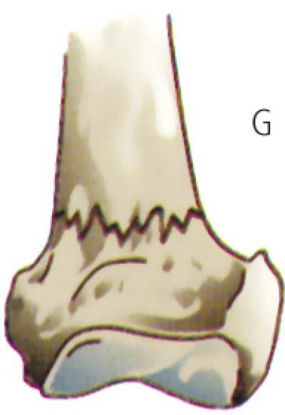 Frattura del collo del femore: definizione e significato medico ...