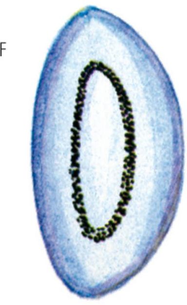 Cataratta: definizione e significato medico | Corriere Salute