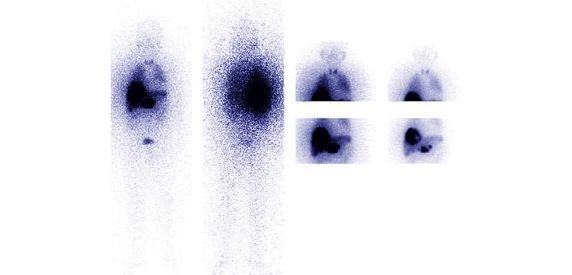 Lipiodol: definizione e significato medico | Corriere Salute