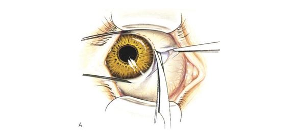 Strabismo: definizione e significato medico | Corriere Salute