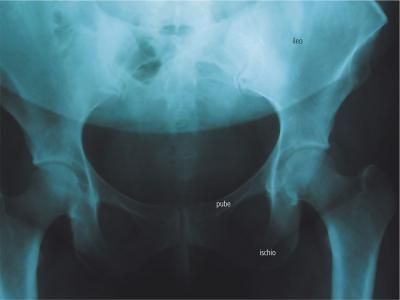 Osso iliaco: definizione e significato medico | Corriere Salute