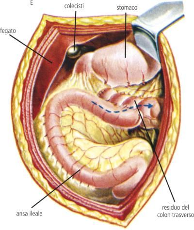 Emicolectomia: definizione e significato medico | Corriere Salute