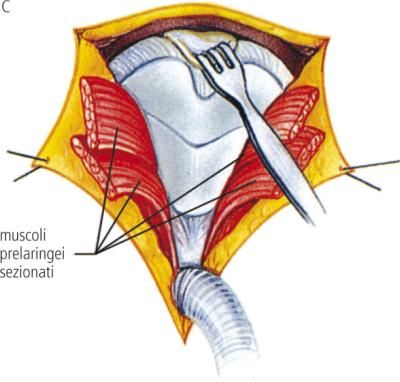 Laringectomia: definizione e significato medico | Corriere Salute