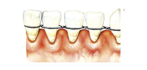 Piorrea: definizione e significato medico | Corriere Salute