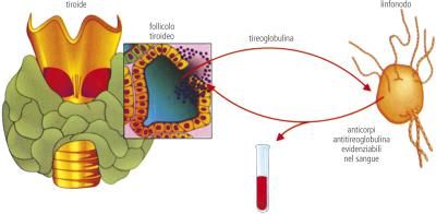 Tiroidite: definizione e significato medico | Corriere Salute