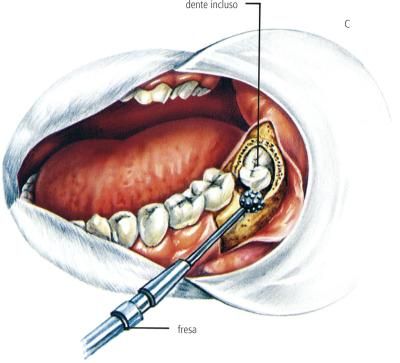 Dente: definizione e significato medico | Corriere Salute