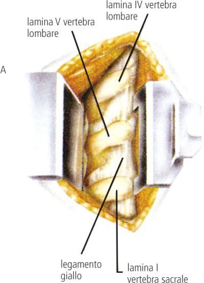 Discectomia: definizione e significato medico | Corriere Salute