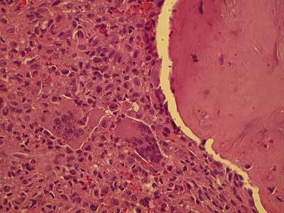 Condroblastoma: definizione e significato medico | Corriere Salute