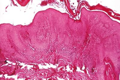 Pinta: definizione e significato medico | Corriere Salute