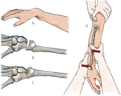 Frattura del polso: definizione e significato medico | Corriere Salute