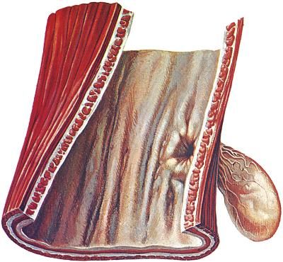 Diverticolo esofageo: definizione e significato medico | Corriere Salute