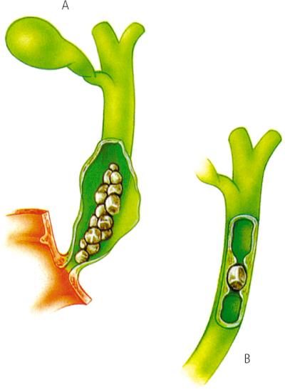 Calcolosi: definizione e significato medico | Corriere Salute