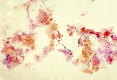 Glossite: definizione e significato medico | Corriere Salute