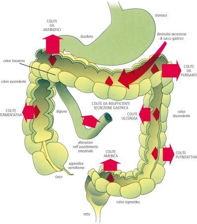 Colite: definizione e significato medico | Corriere Salute