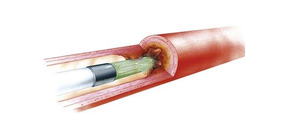Angioplastica: definizione e significato medico | Corriere Salute