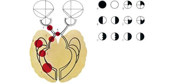 Emianopsia: definizione e significato medico | Corriere Salute