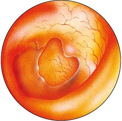 Otite: definizione e significato medico | Corriere Salute