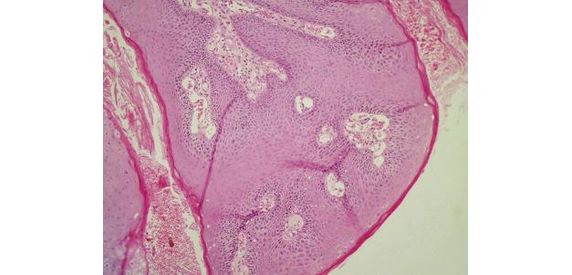 Condiloma: definizione e significato medico | Corriere Salute